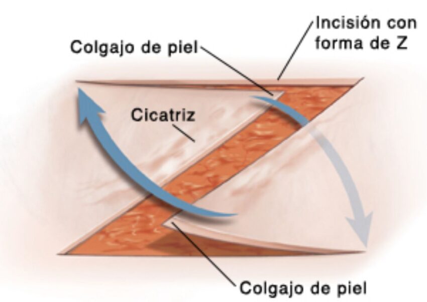 FINANCIACION CIRUGIA PLASTICA - PROCEDIMIENTOS: ZETAPLASTIA